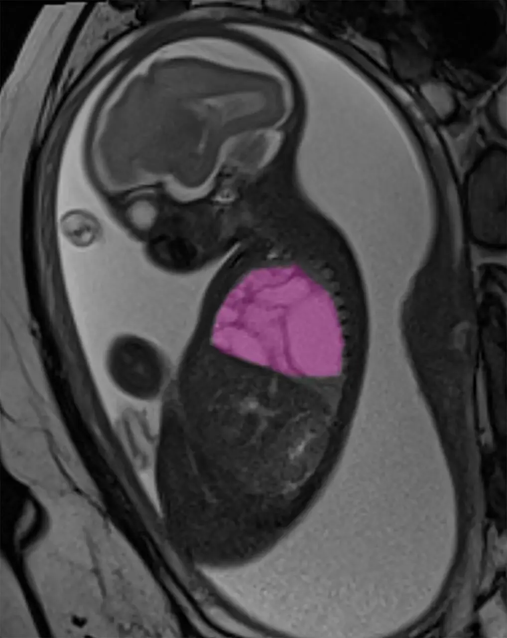 Operato in utero per cisti gigante polmone piccolo sta bene